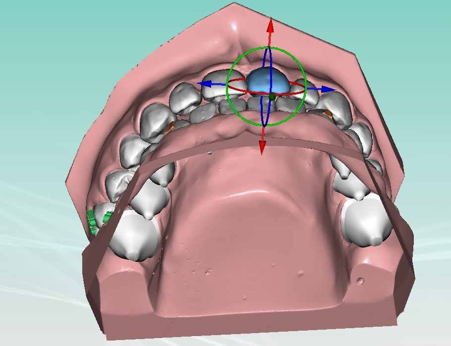 Gouttières d’alignement – e-DENTIC.CH