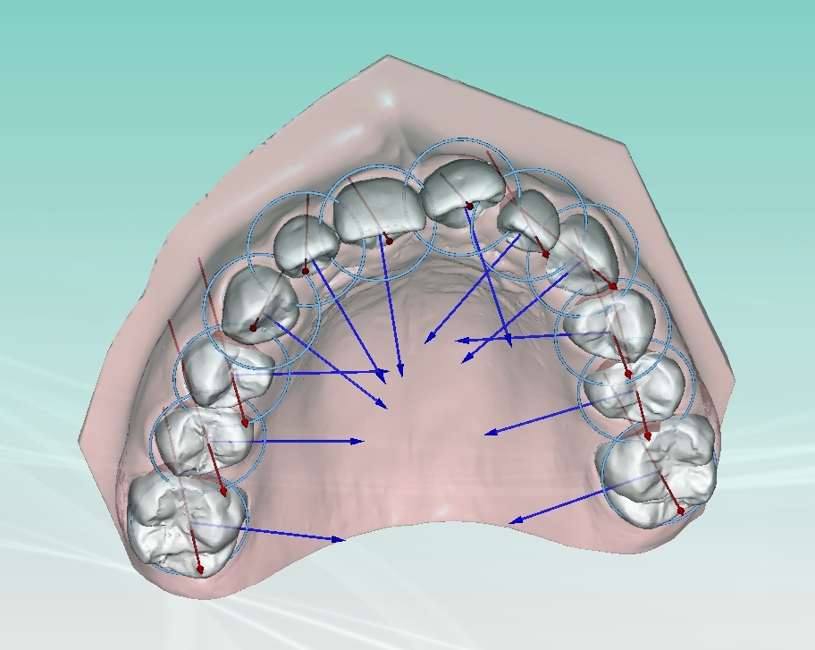 Gouttières d’alignement – e-DENTIC.CH